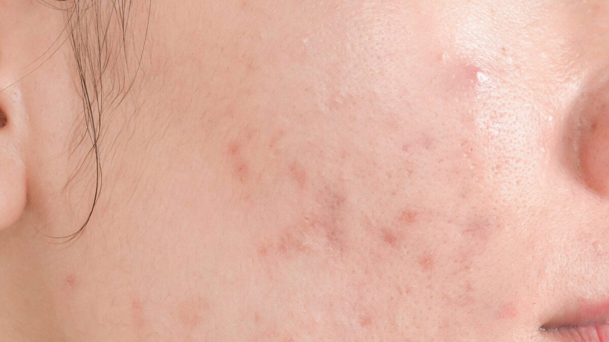 Congested Skin: Causes and Professional Treatments - The Cosmetic ...