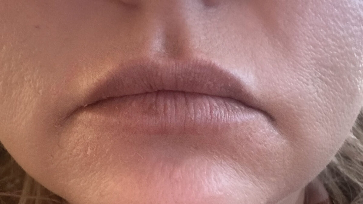 Downturned Mouth: Causes & Treatments - The Cosmetic Studio Noosa