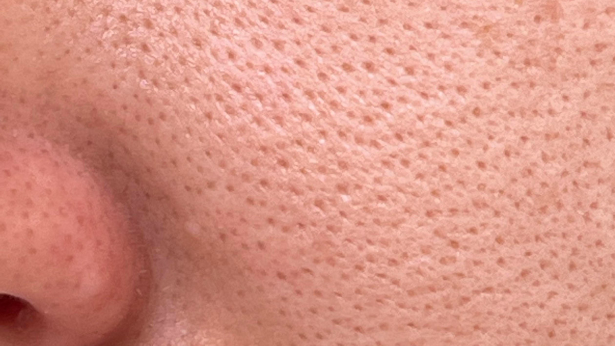 What Is the Best Treatment for Enlarged Pores? - The Cosmetic Studio Noosa