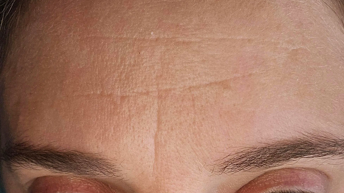 Forehead Lines - The Cosmetic Studio Noosa