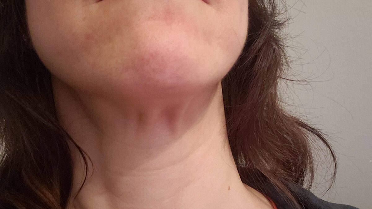 How to Treat Sagging Neck Skin Without Surgery - The Cosmetic Studio Noosa