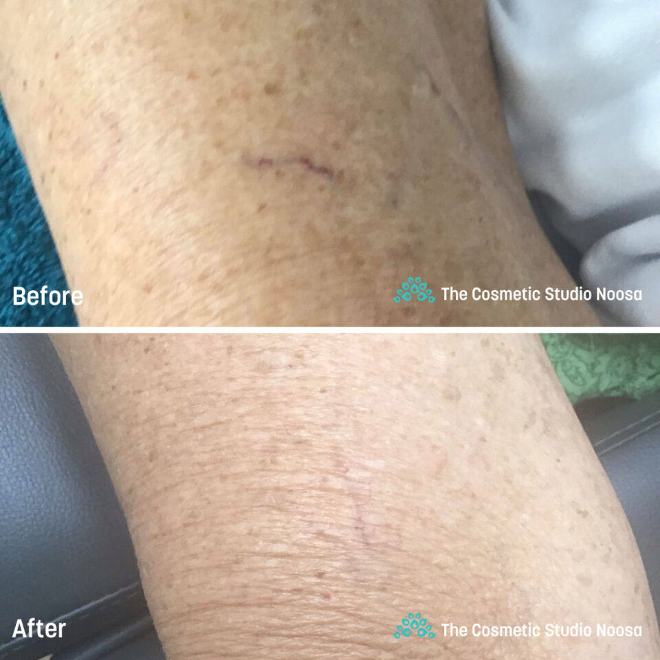 Leg Spider Vein Treatment in Noosa on the Sunshine Coast