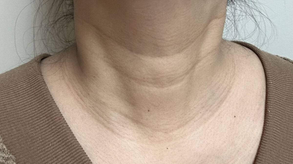 Neck Bands: Platysmal Band Treatment Solutions - The Cosmetic Studio Noosa