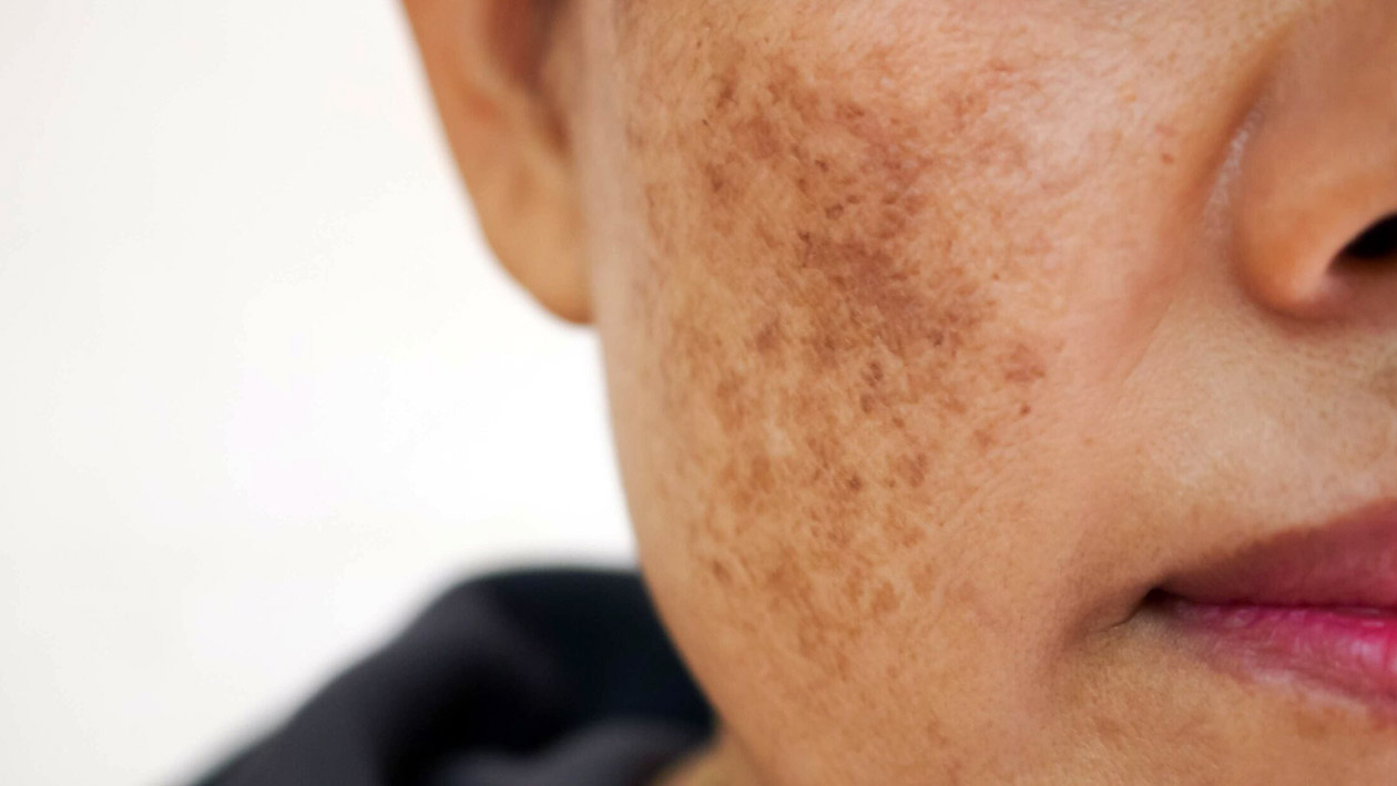 What is Pigmentation? - The Cosmetic Studio Noosa